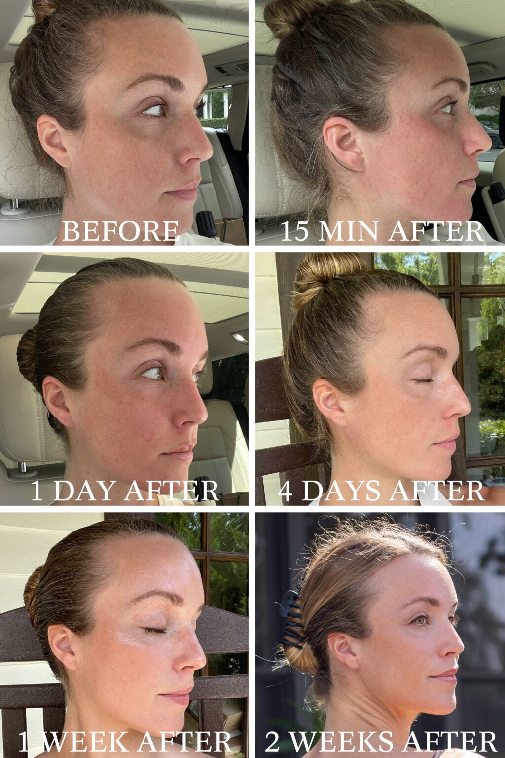 My MOXI Laser Treatment Review with Before & Afters – Natalie Yerger